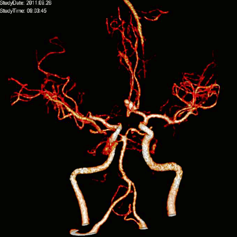 Second Life Marketplace - Sanna CTA Intracranial Brain Arteries Aneurysm MP
