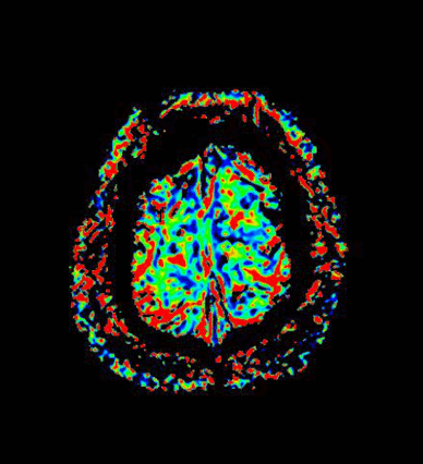 Second Life Marketplace - Sanna Brain MRI Perfusion Scan Infarction SET MP